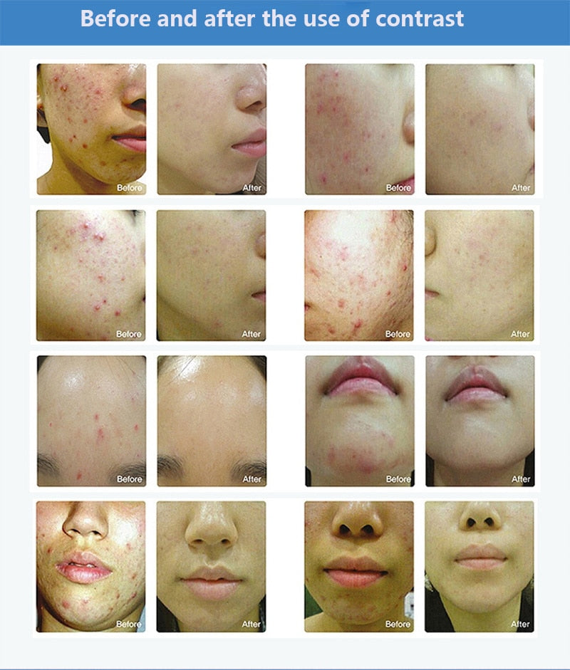 Professional Photon PDT Led Light Facial Mask Machine 7 Colors