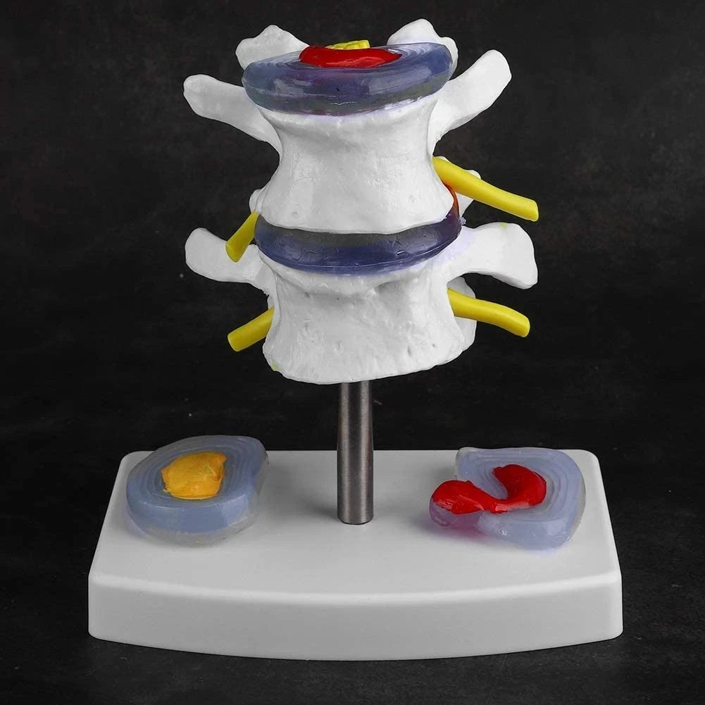 Intervertebral Disc Herniation Bone Pathology Model Lumbar Spine Bone ...