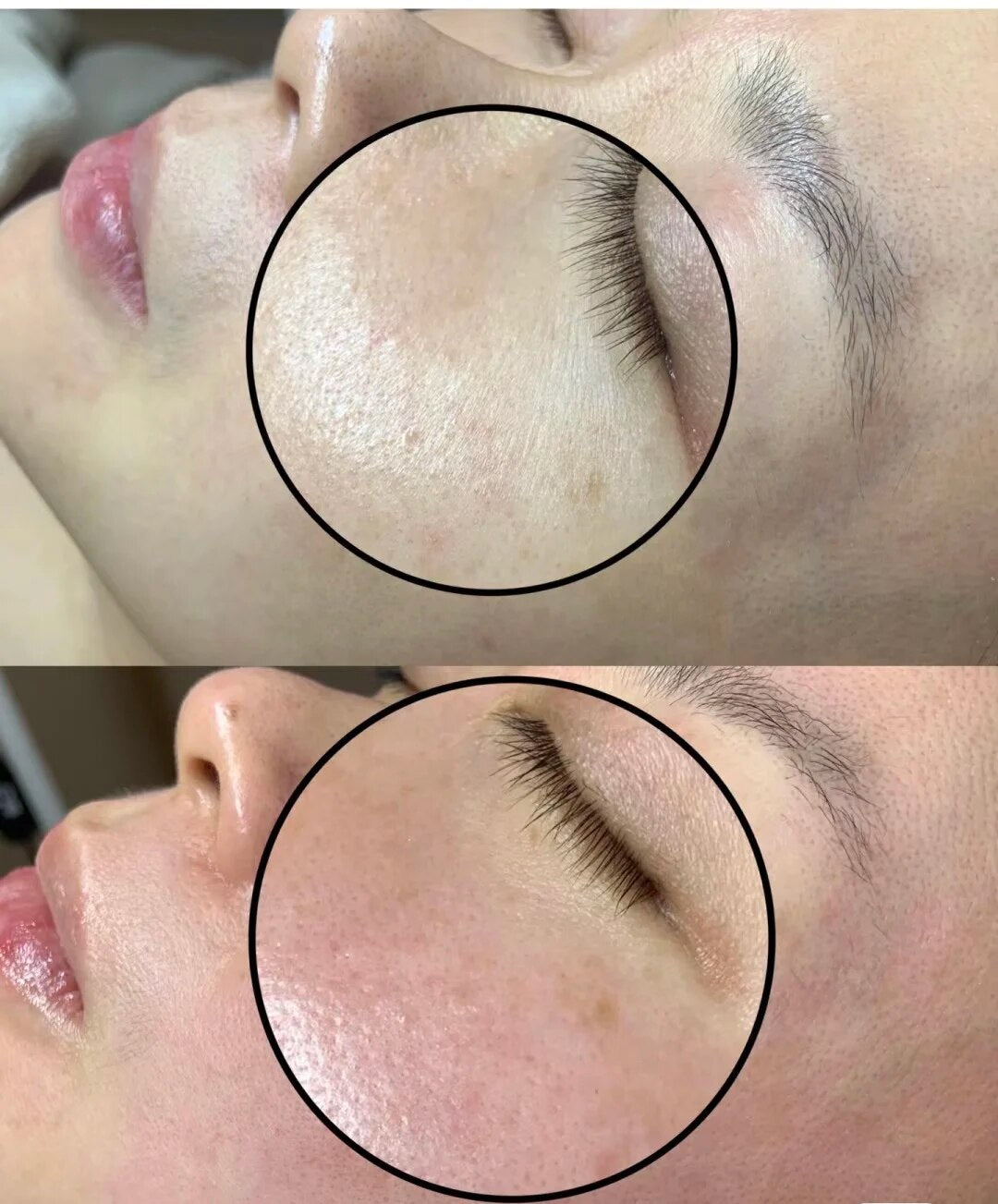 Portable Morpheus 8 Professional Machine Radio Frequency Gold Micro ...